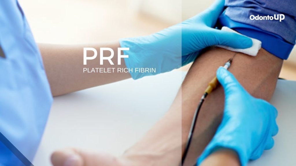 PRF: Fibrina Rica em Plaquetas - Odonto Up